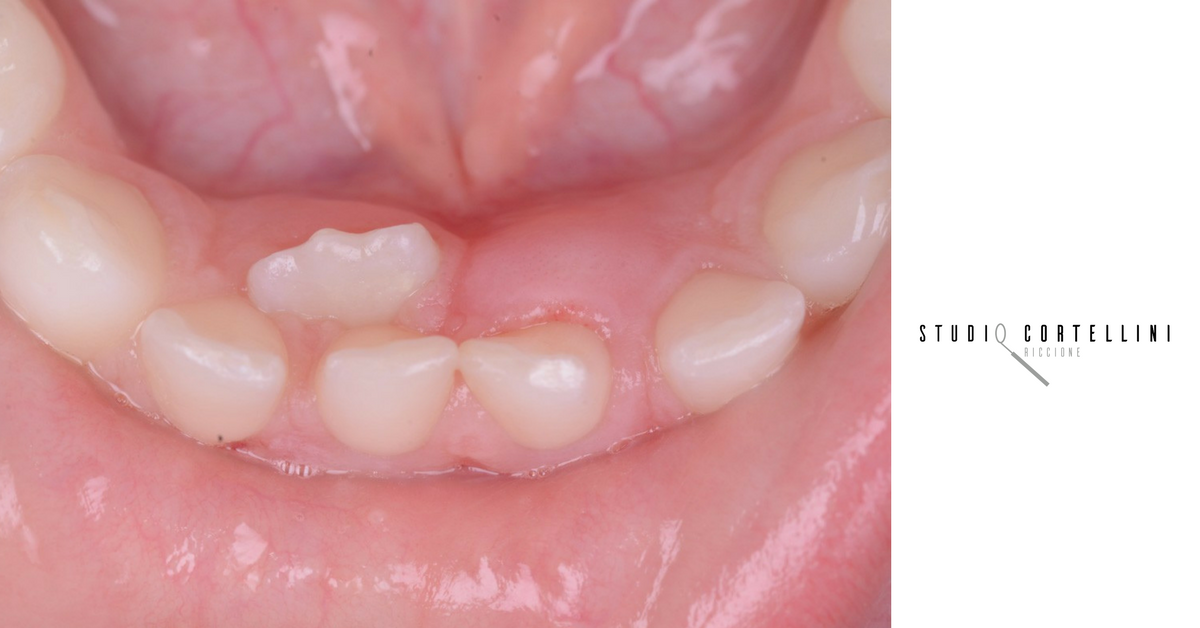 DENTINI STORTI: E’ normale che gli incisivi inferiori permanenti ...